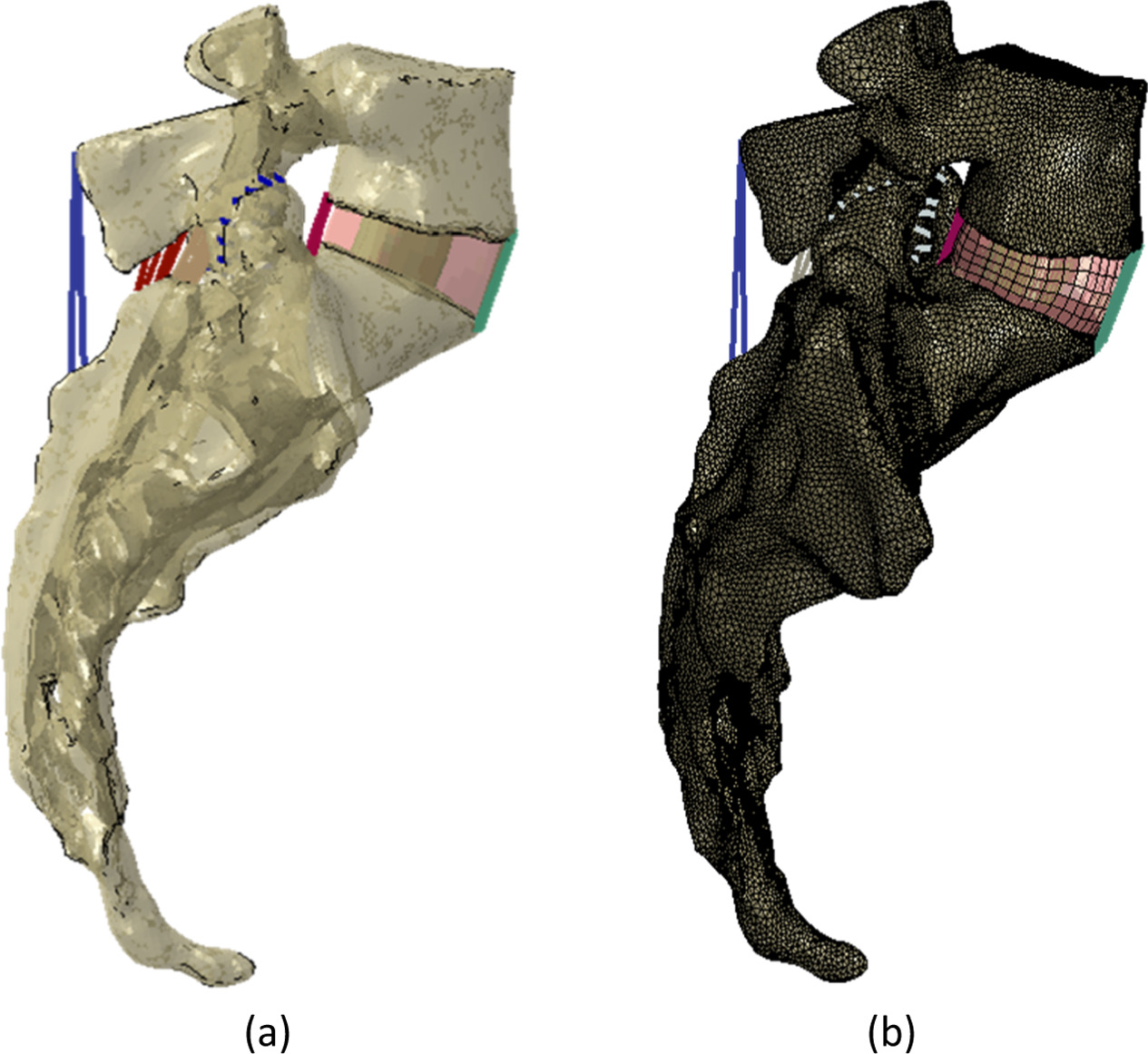 In-silico study on cumulative effects of degeneration and anterior ...