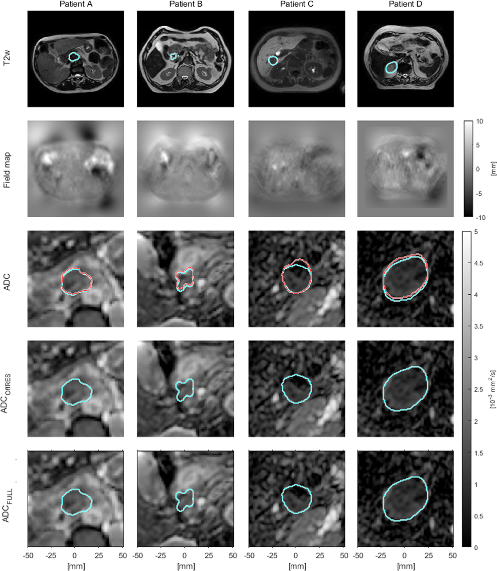 Impact of geometric correction on echo-planar imaging-based apparent ...