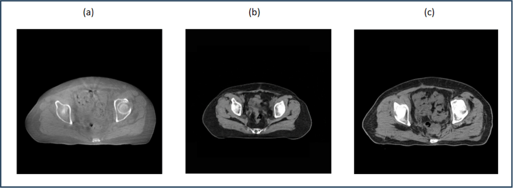 Synthetic CT generation from CBCT based on structural constraint cycle ...