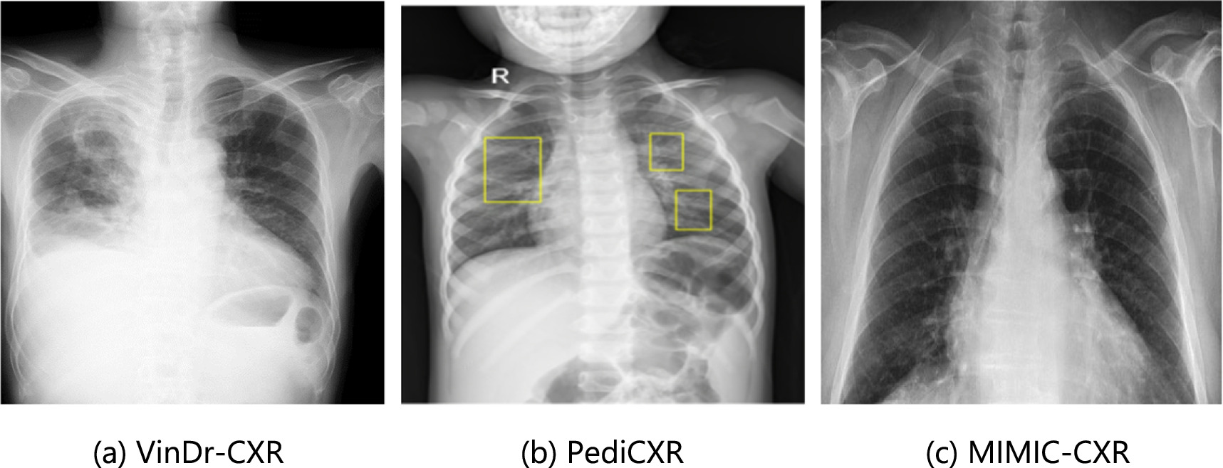 Optimizing pulmonary chest x-ray classification with stacked feature ...
