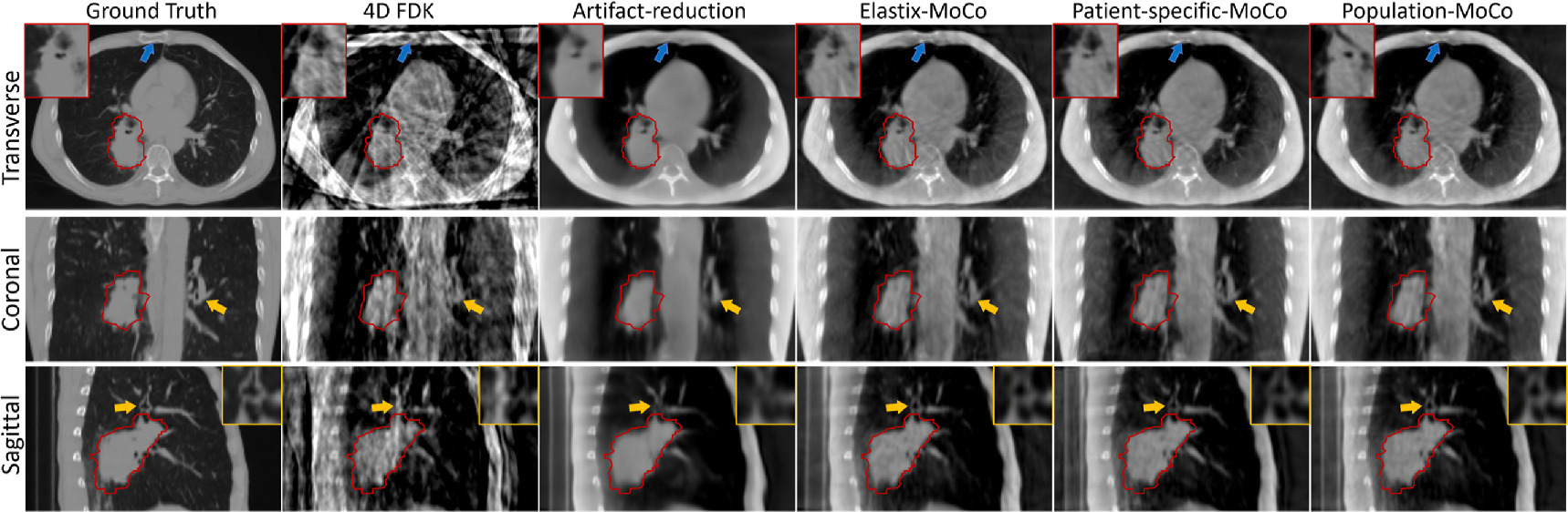 Fast motion-compensated reconstruction for 4D-CBCT using deep learning ...