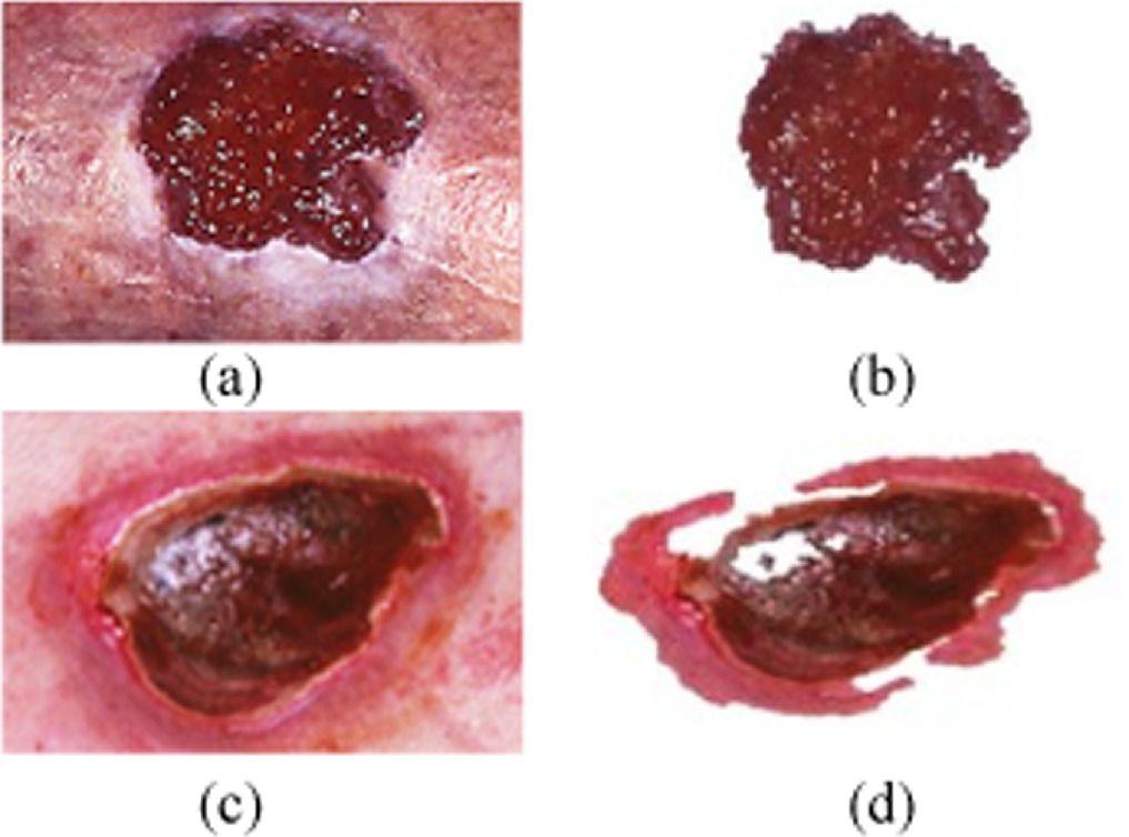 Intelligent progress monitoring of healing wound tissues based on ...