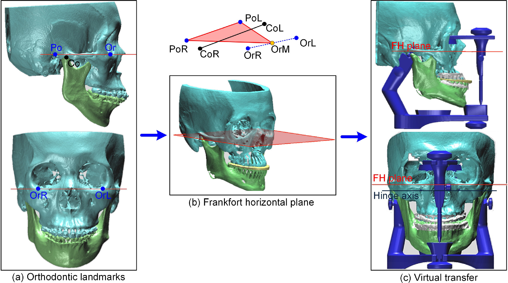 A facebow-free technique for mechanical articulator remounting using ...