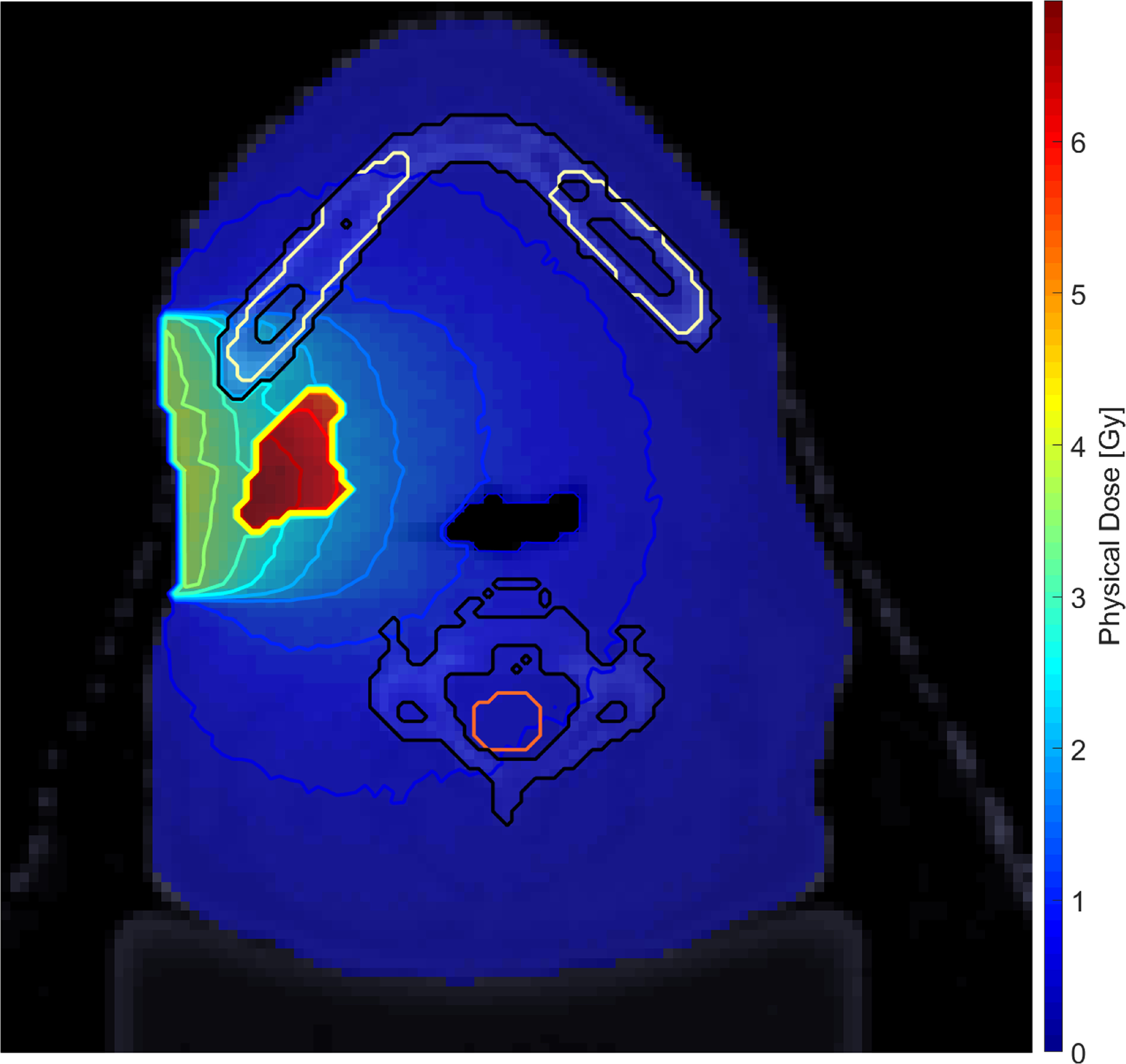 A Monte Carlo dose engine for fast neutron therapy and boron neutron ...