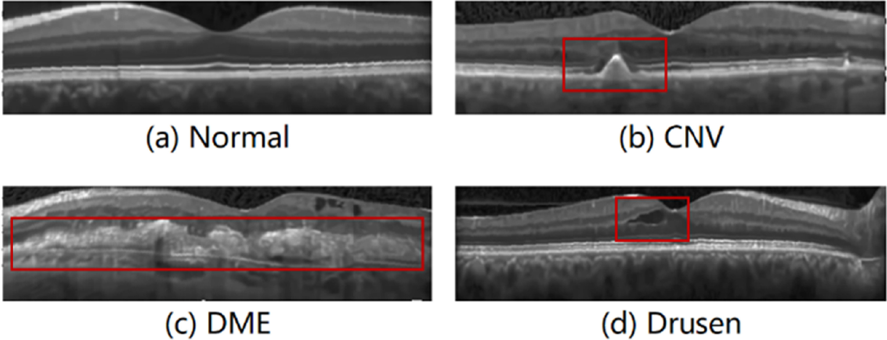 An OCT retinal image classification model based on improved ResNet-34 ...
