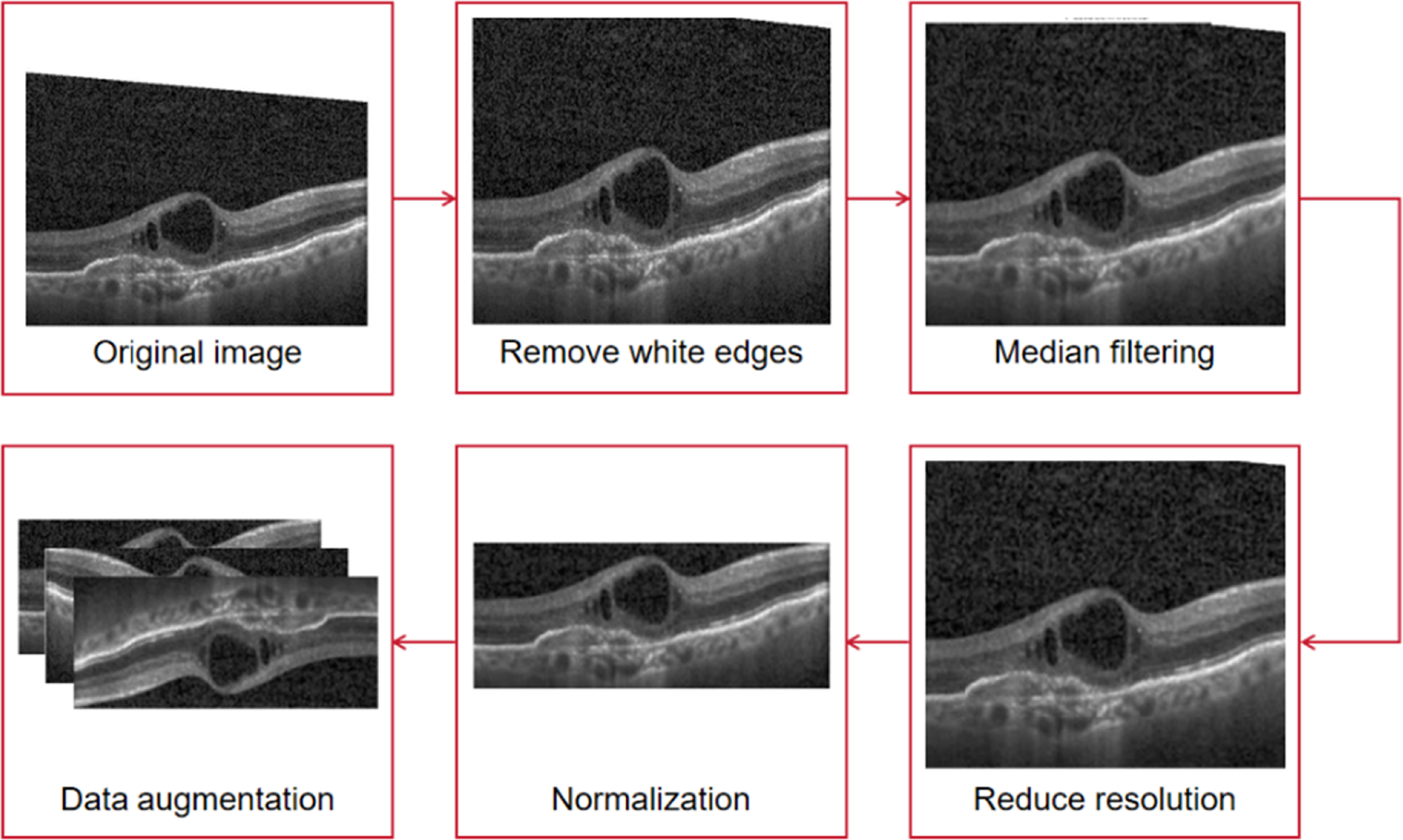 An OCT retinal image classification model based on improved ResNet-34 ...