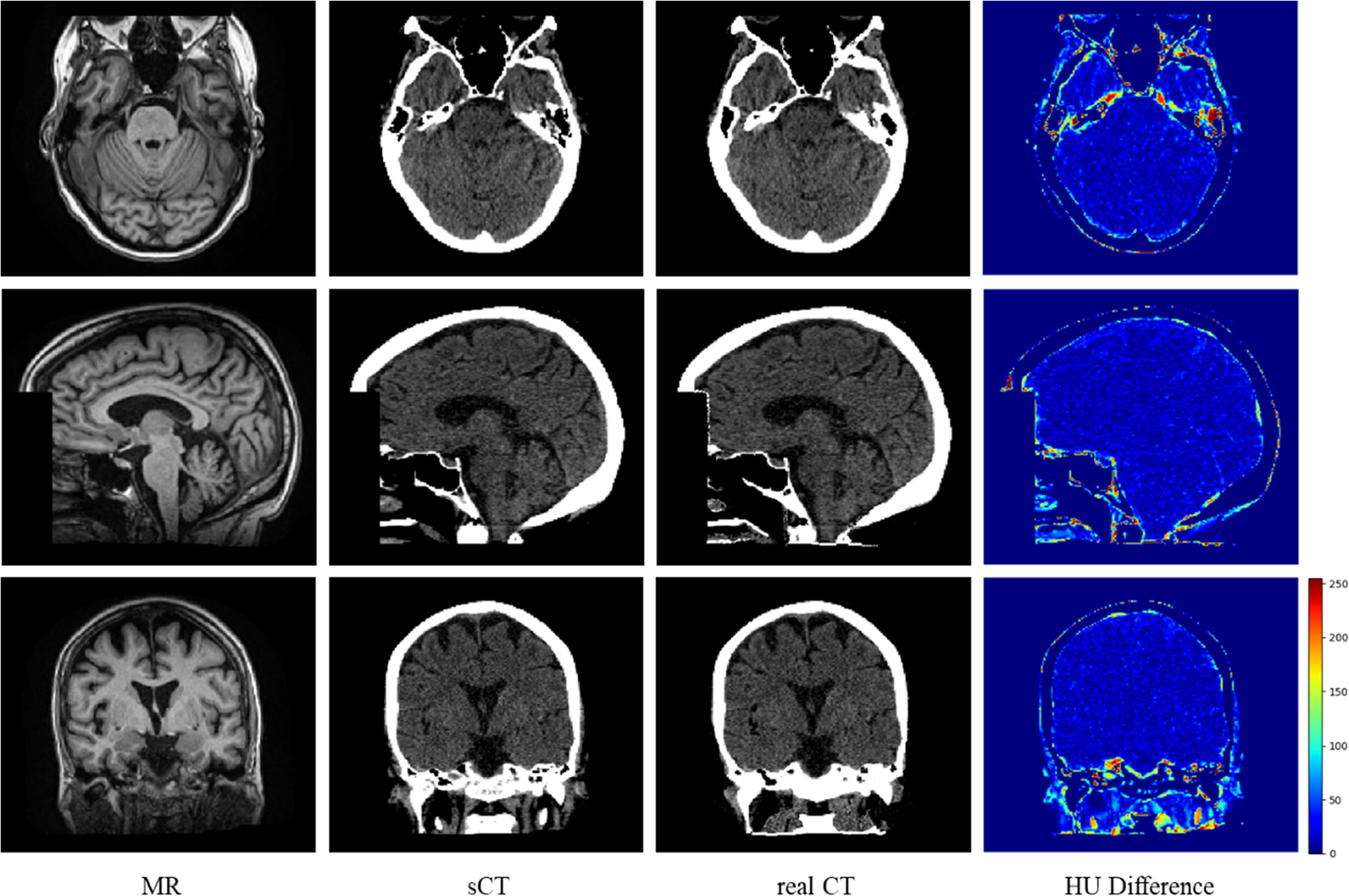 MR-based synthetic CT generation using dual-attention enhanced 3D ...