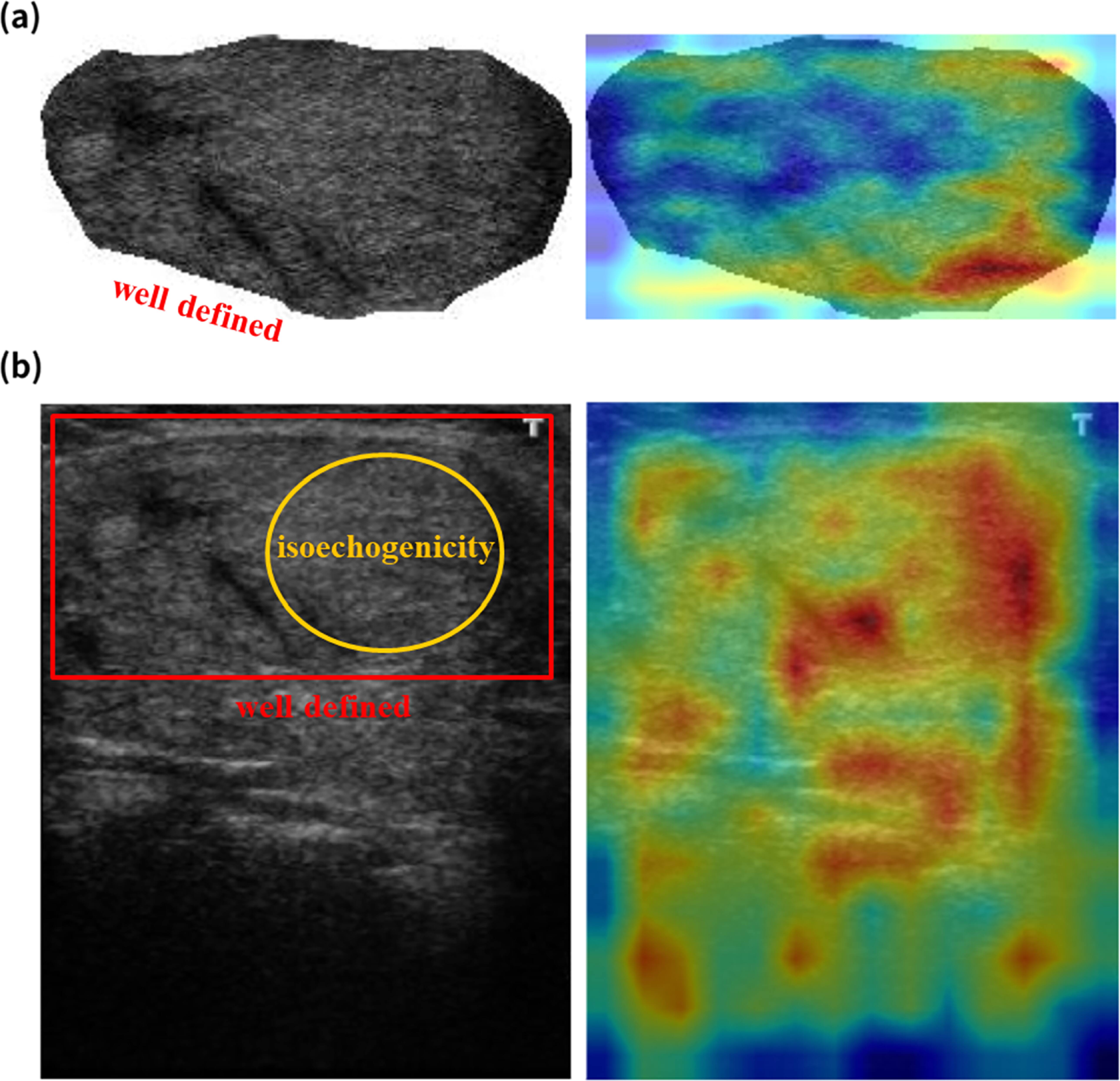A ResNet-ViT classification model for thyroid nodules using ultrasound ...