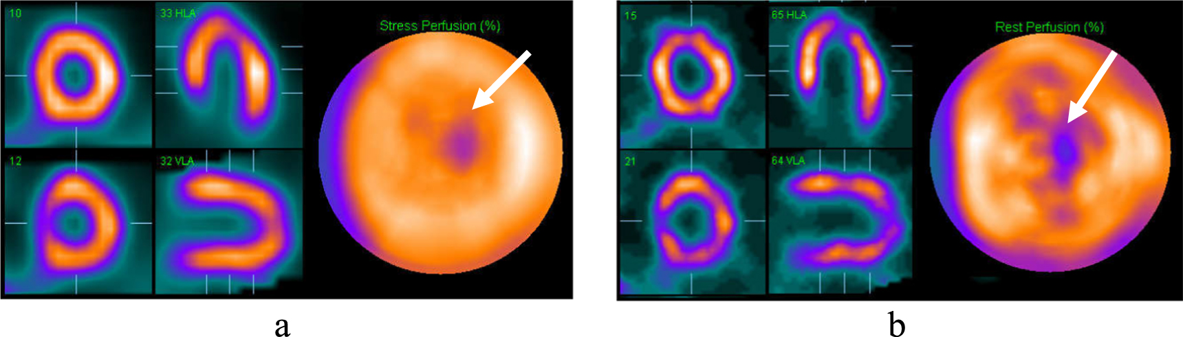A study of false apical defects in myocardial perfusion imaging with ...
