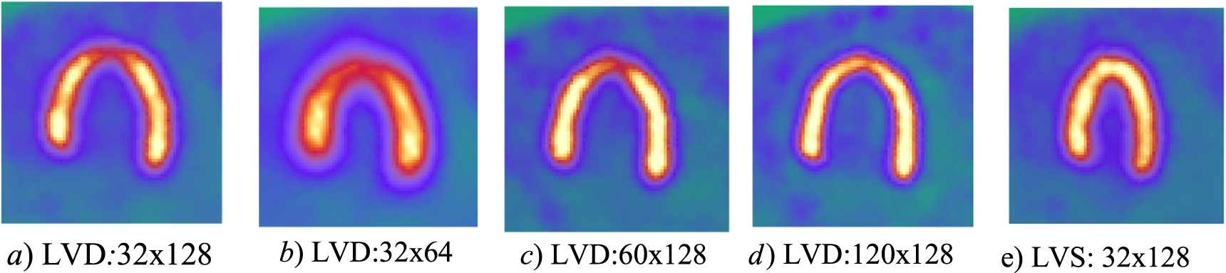 A study of false apical defects in myocardial perfusion imaging with ...