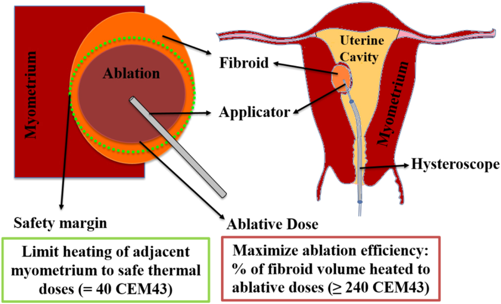 Transcervical microwave ablation in type 2 uterine fibroids via a ...