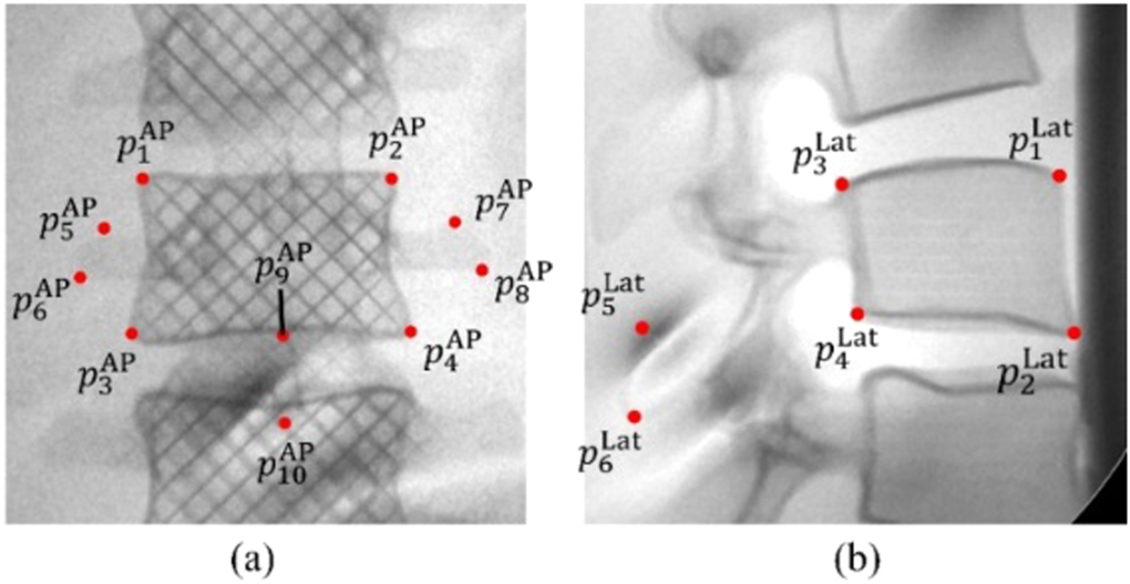 Reconstruction of three-dimensional lumbar vertebrae from biplanar x ...
