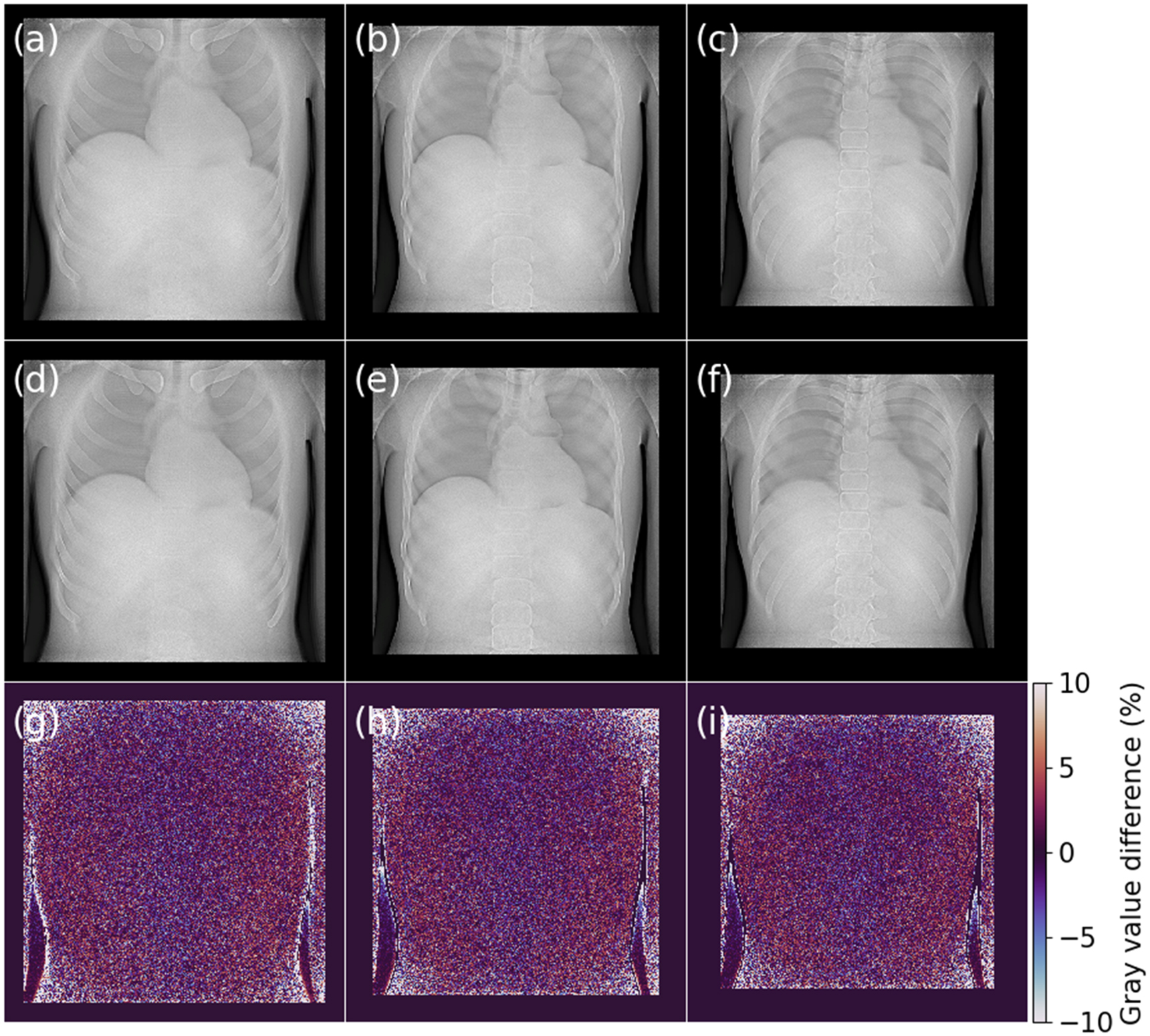 3D chest tomosynthesis using a stationary flat panel source array and a ...