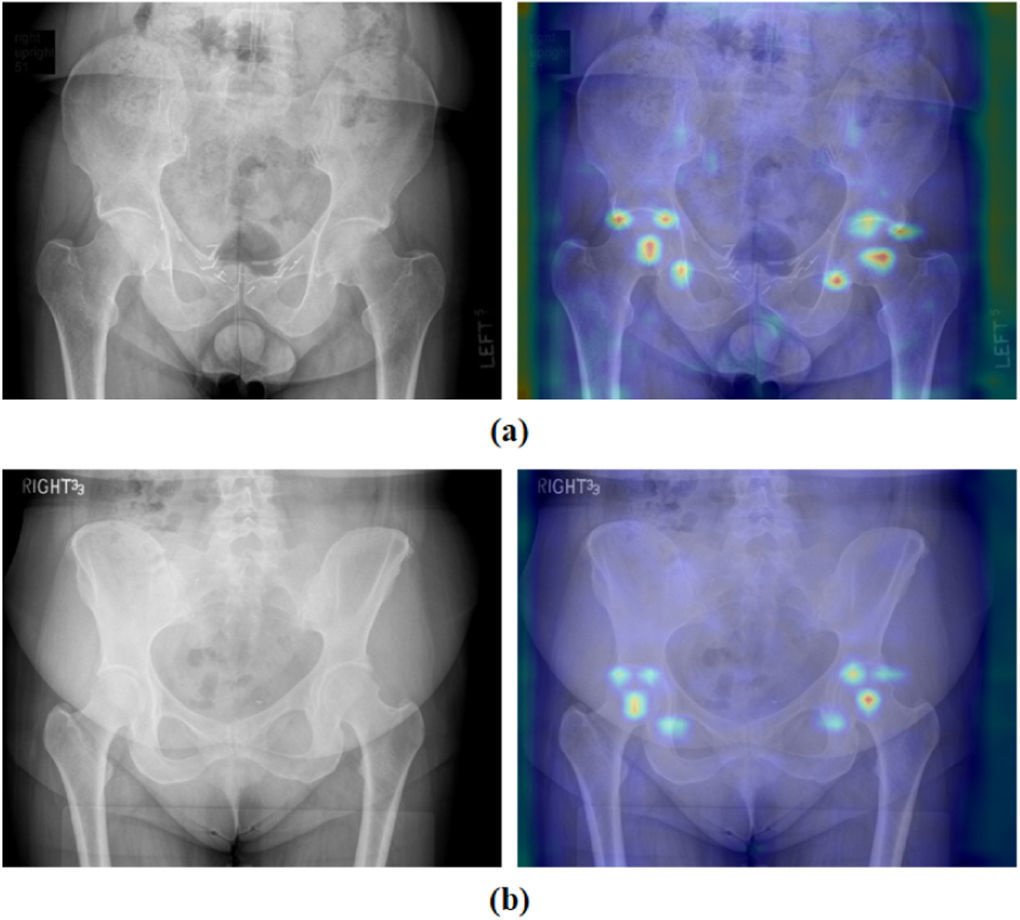 Learning-based landmark detection in pelvis x-rays with attention ...