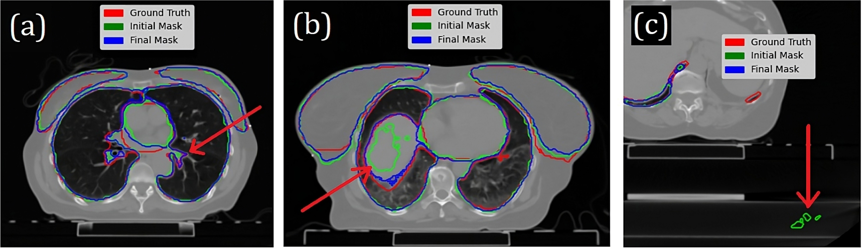 Auto-segmentation of thoracic organs in CT scans of breast cancer ...