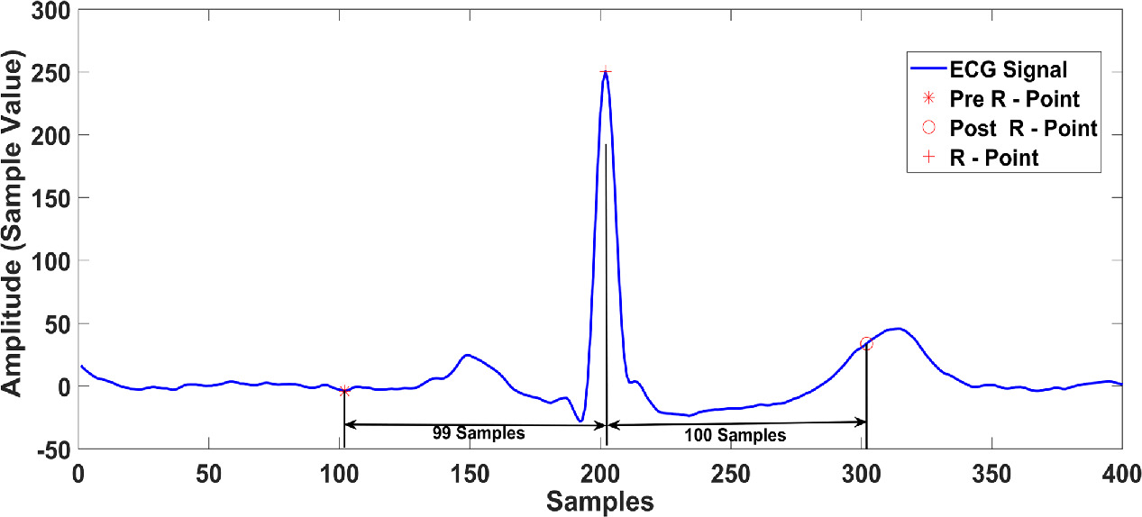Electrocardiogram morphological arrhythmia classification using fuzzy entropy-based feature ...