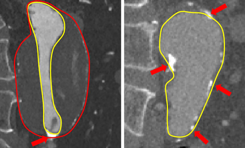 Deep-learning-based image segmentation for image-based computational hemodynamic analysis of ...