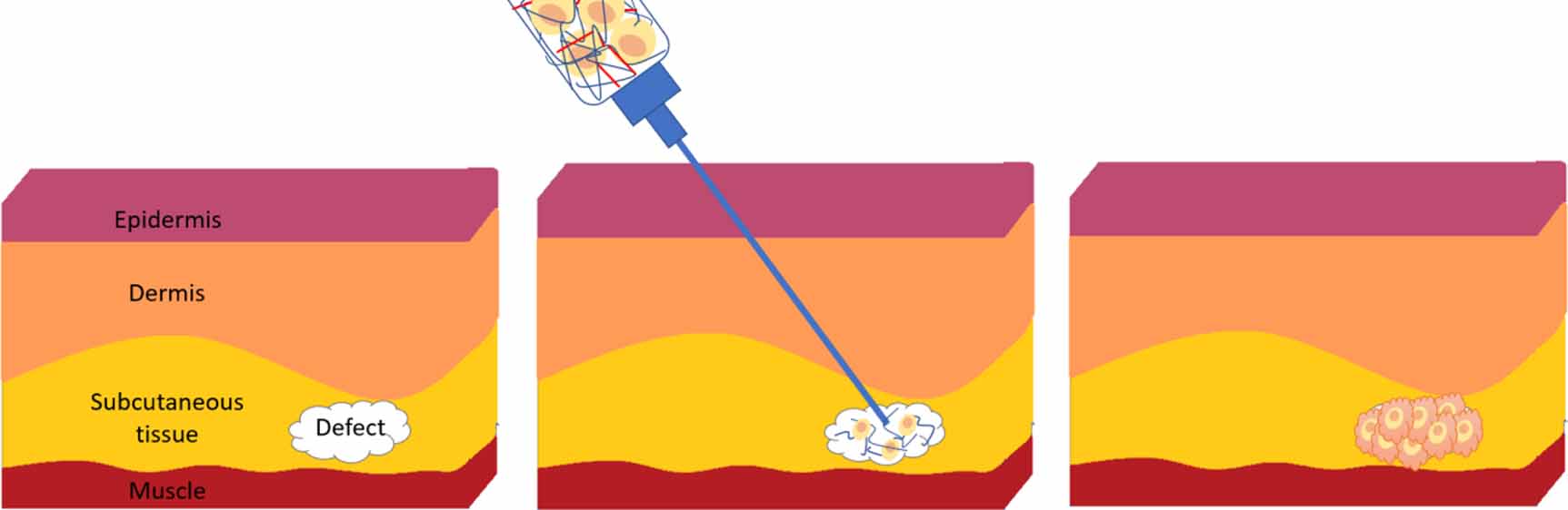 Injectable biomaterials as minimal invasive strategy towards soft ...