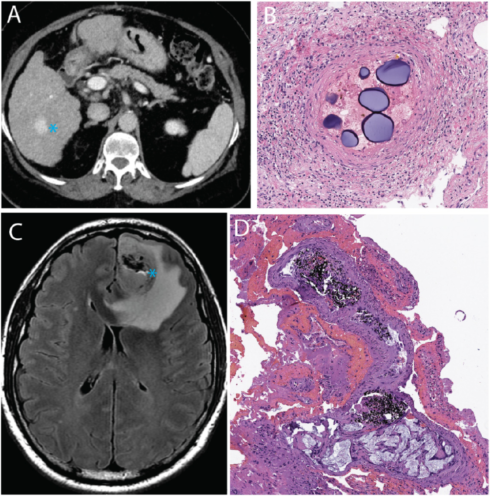 Emerging embolic agents in endovascular embolization: an overview ...