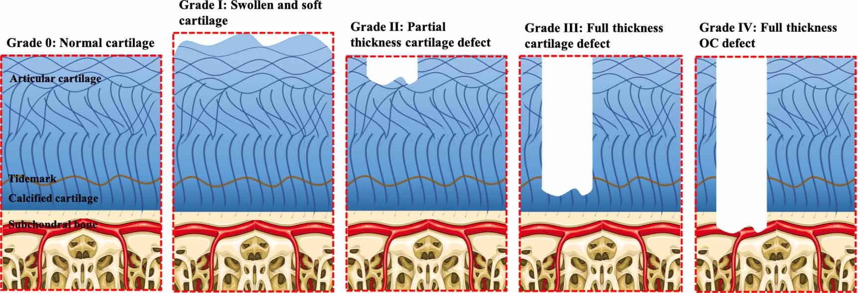 Advances on gradient scaffolds for osteochondral tissue engineering ...
