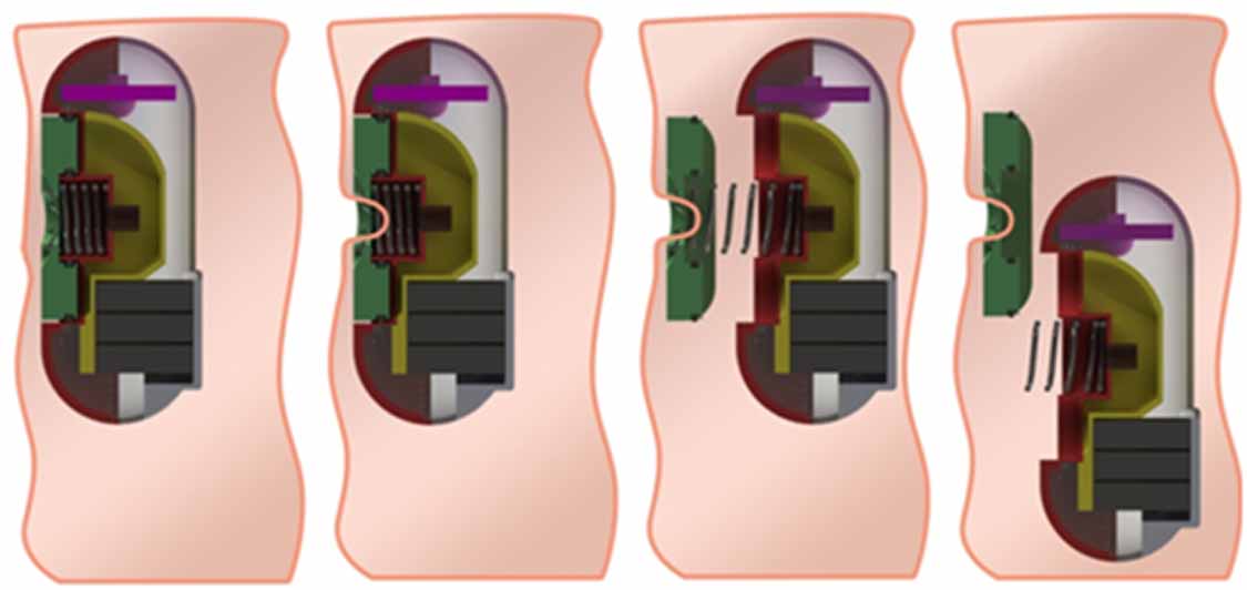 Ingestible devices for long-term gastrointestinal residency: a review ...