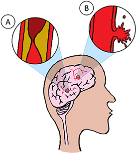 Post-stroke upper limb rehabilitation: clinical practices, compensatory ...
