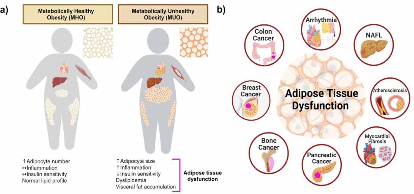 Tissue engineered models of adipose tissue dysfunction to investigate ...