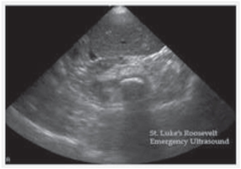 Detection of kidney stone using digital image processing: a holistic ...