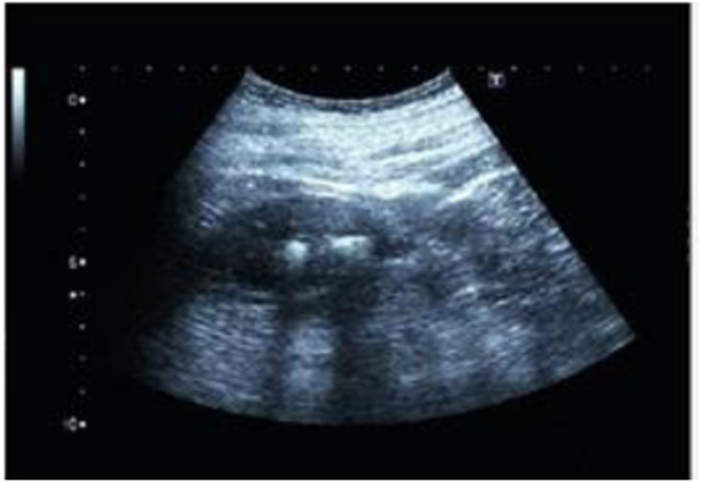 Detection of kidney stone using digital image processing: a holistic ...