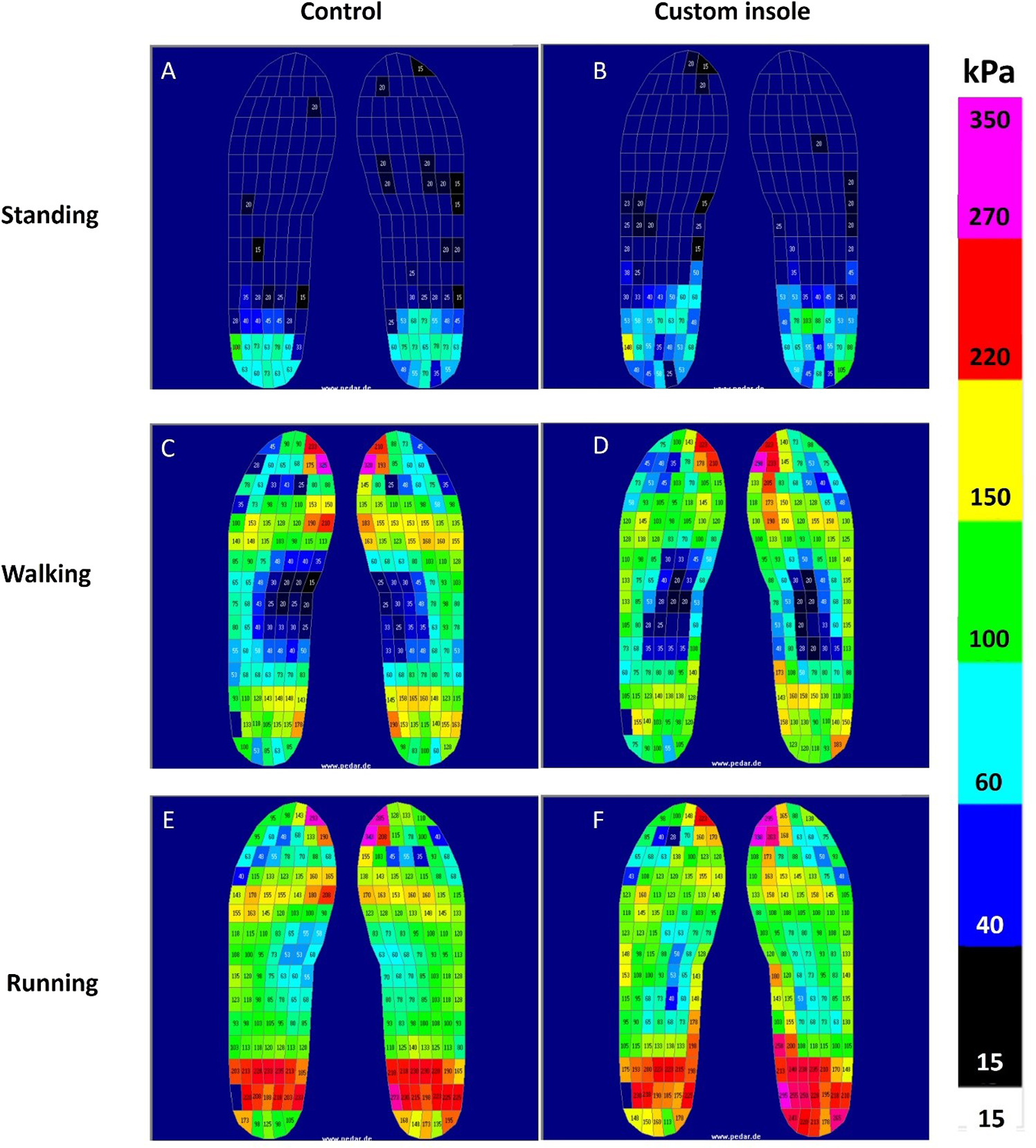 Plantar pressure distribution using personalised 3D printed lattice ...