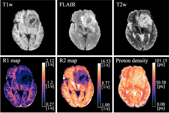 Deep learning-based detection and identification of brain tumor ...