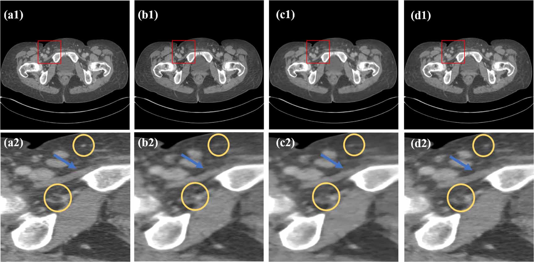 Generation model meets swin transformer for unsupervised low-dose CT ...