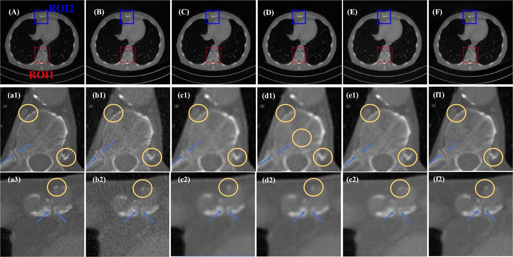 Generation model meets swin transformer for unsupervised low-dose CT ...