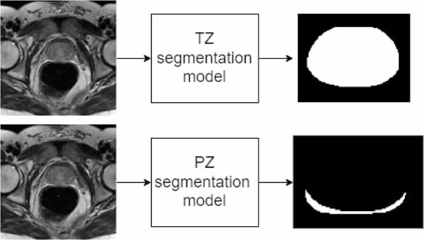 Advancements in prostate zone segmentation: integrating attention ...