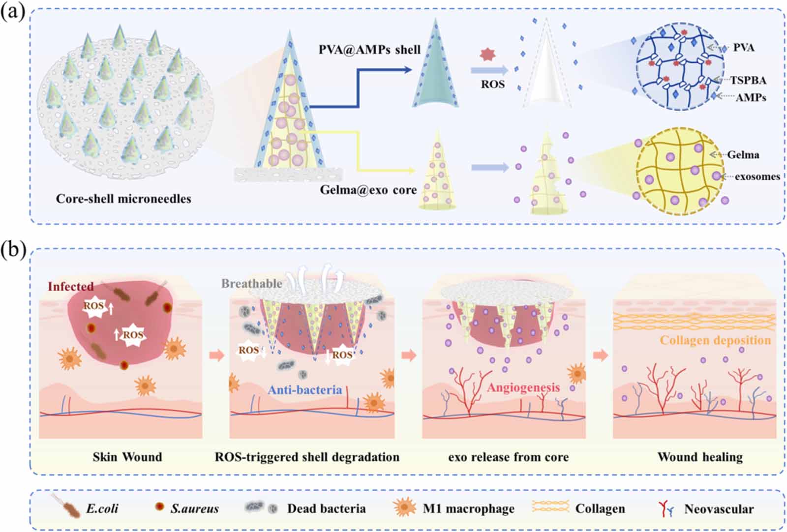 Breathable core–shell microneedle patches for diabetic wound treatment ...