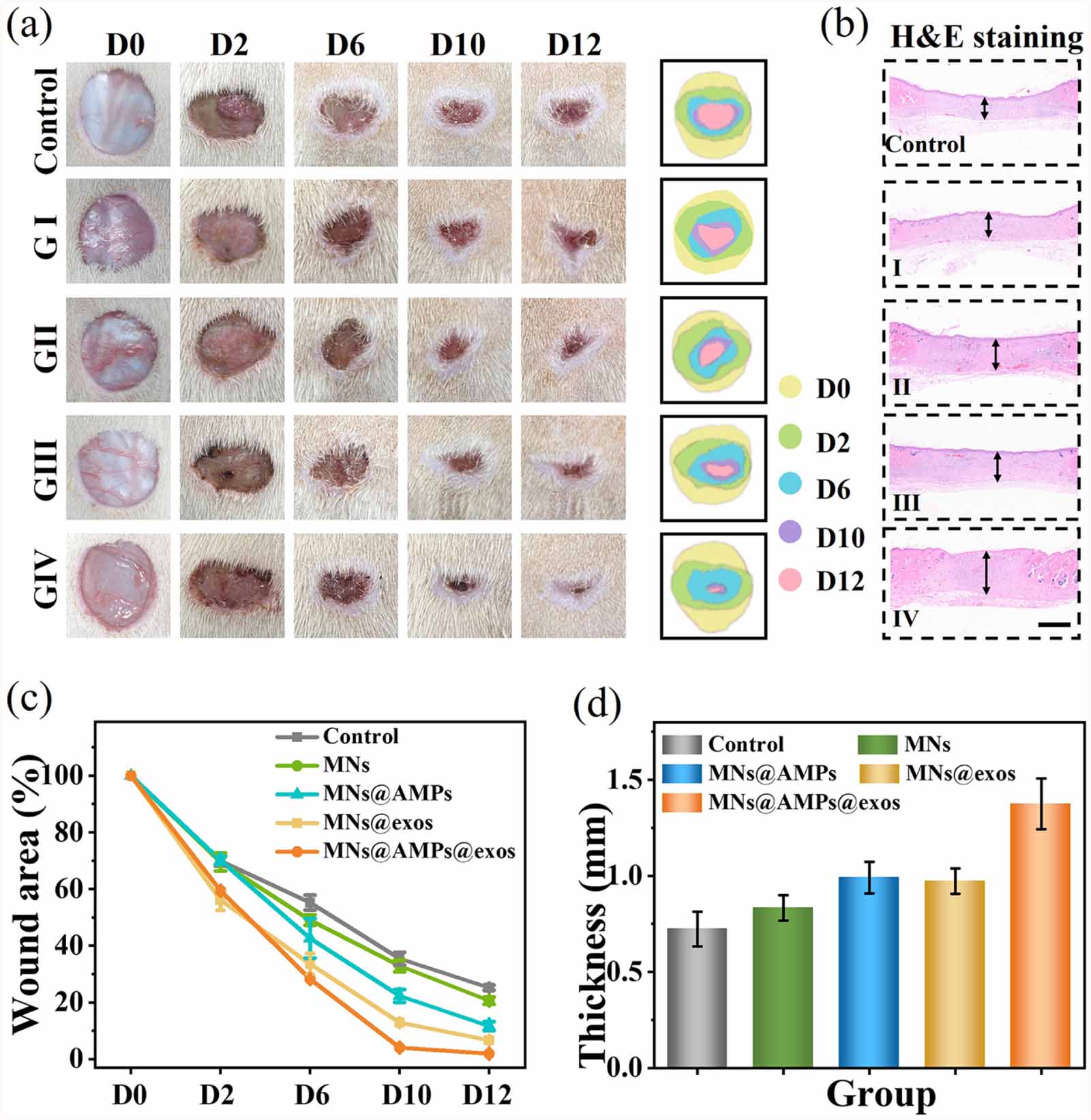 Breathable core–shell microneedle patches for diabetic wound treatment ...