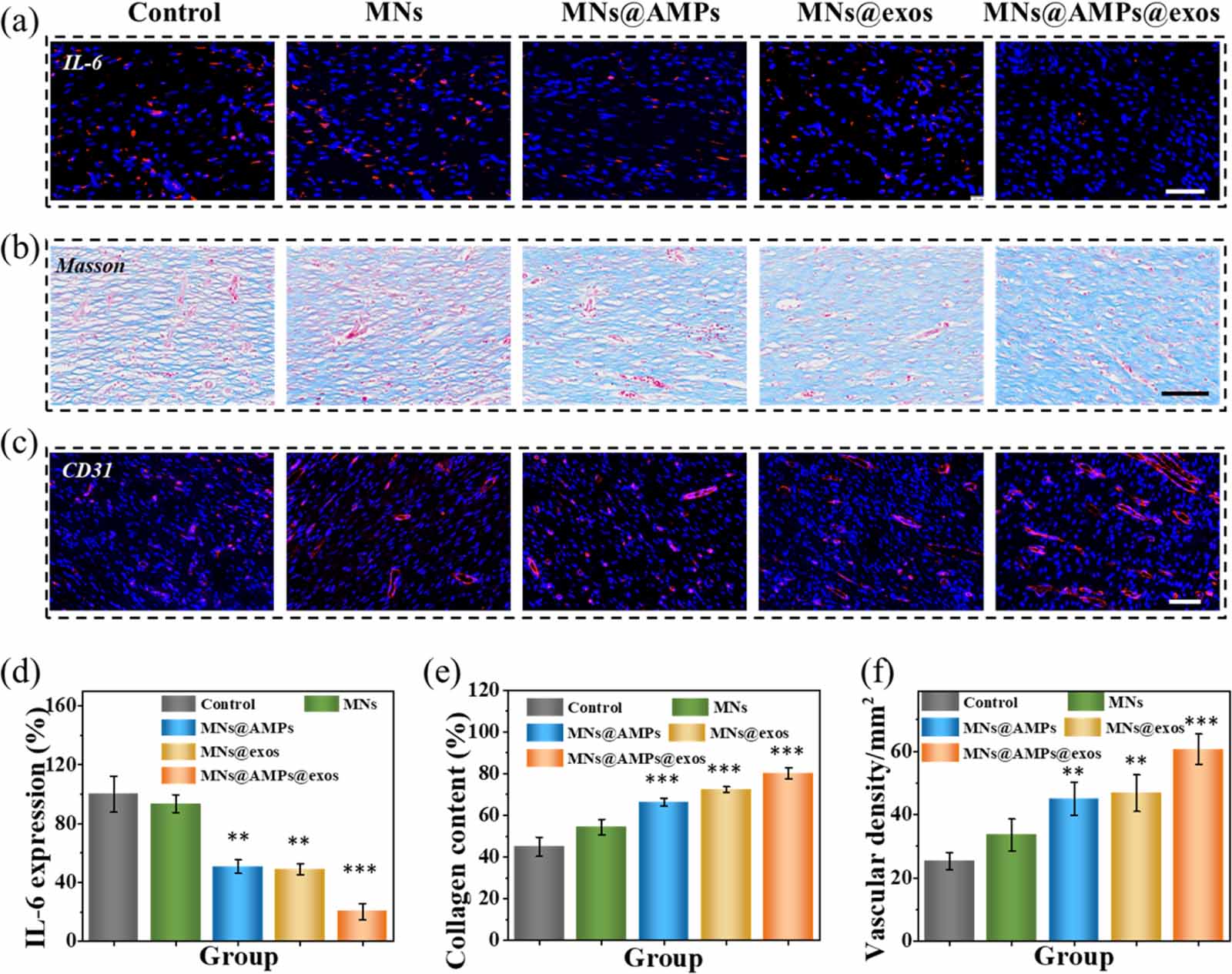 Breathable core–shell microneedle patches for diabetic wound treatment ...